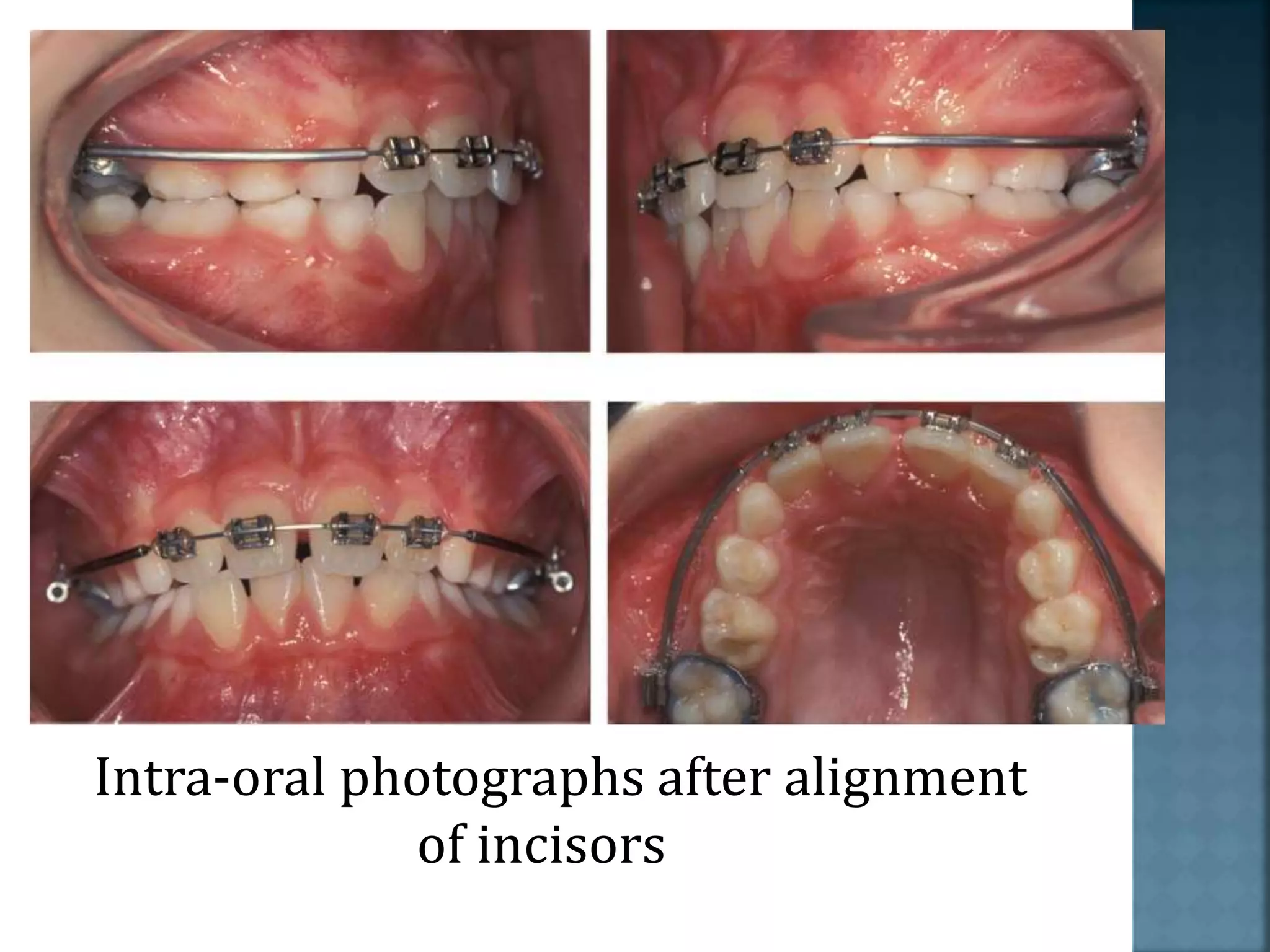 Sectional fixed orthodontic appliance | PPTX