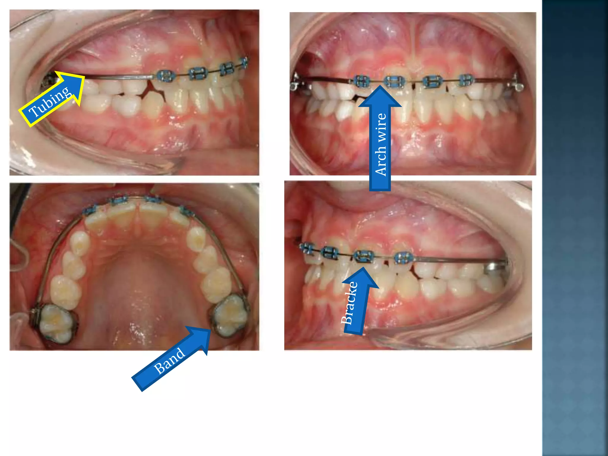 Sectional fixed orthodontic appliance | PPTX