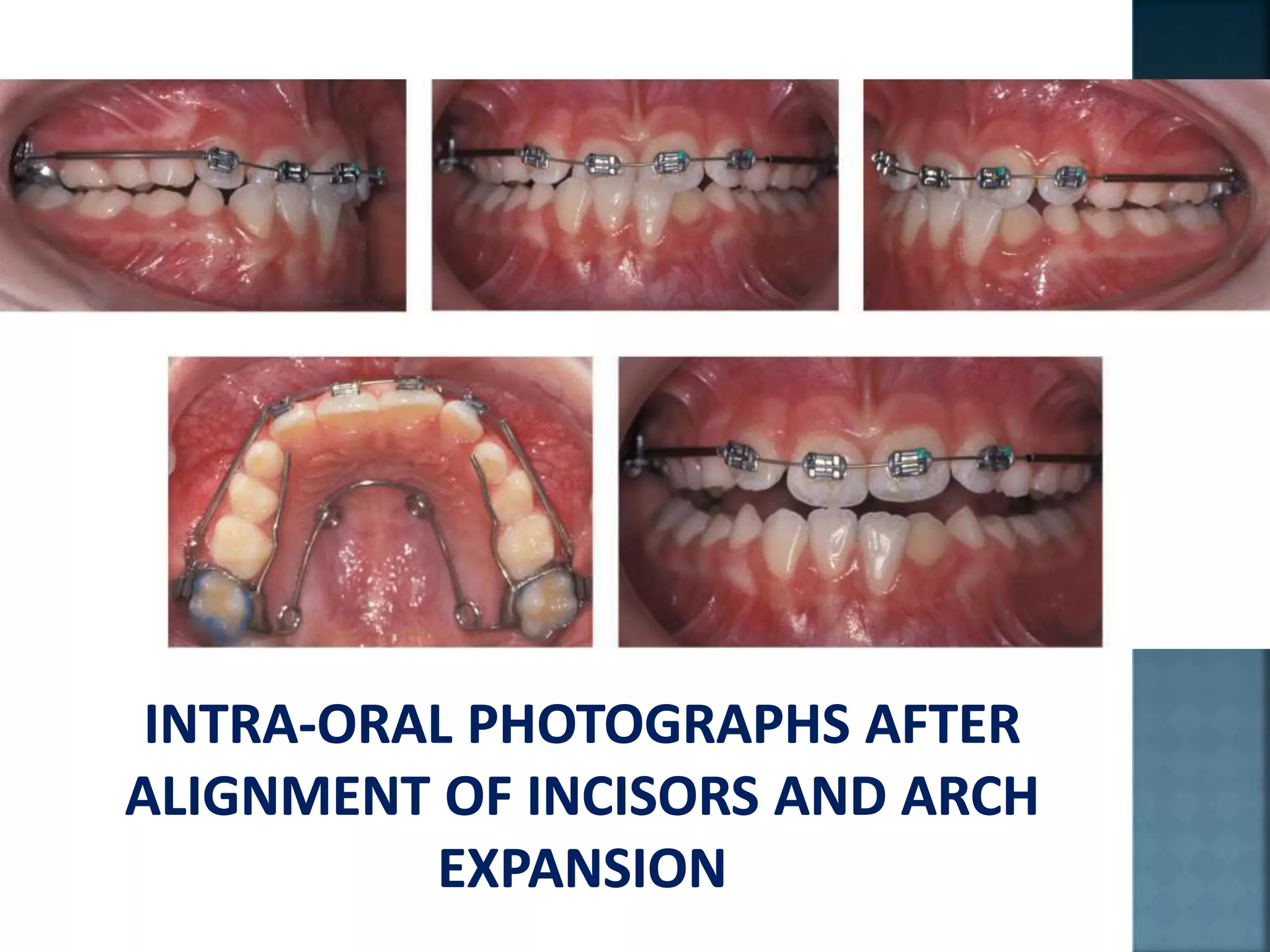 Sectional fixed orthodontic appliance | PPTX