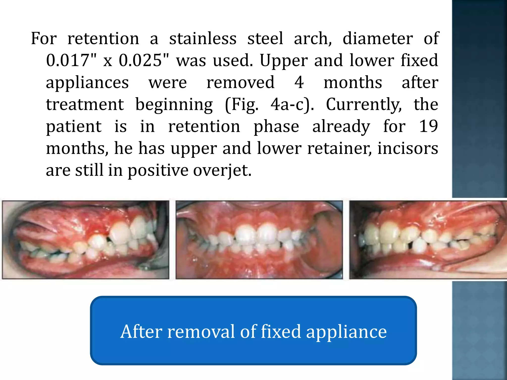 Sectional fixed orthodontic appliance | PPTX