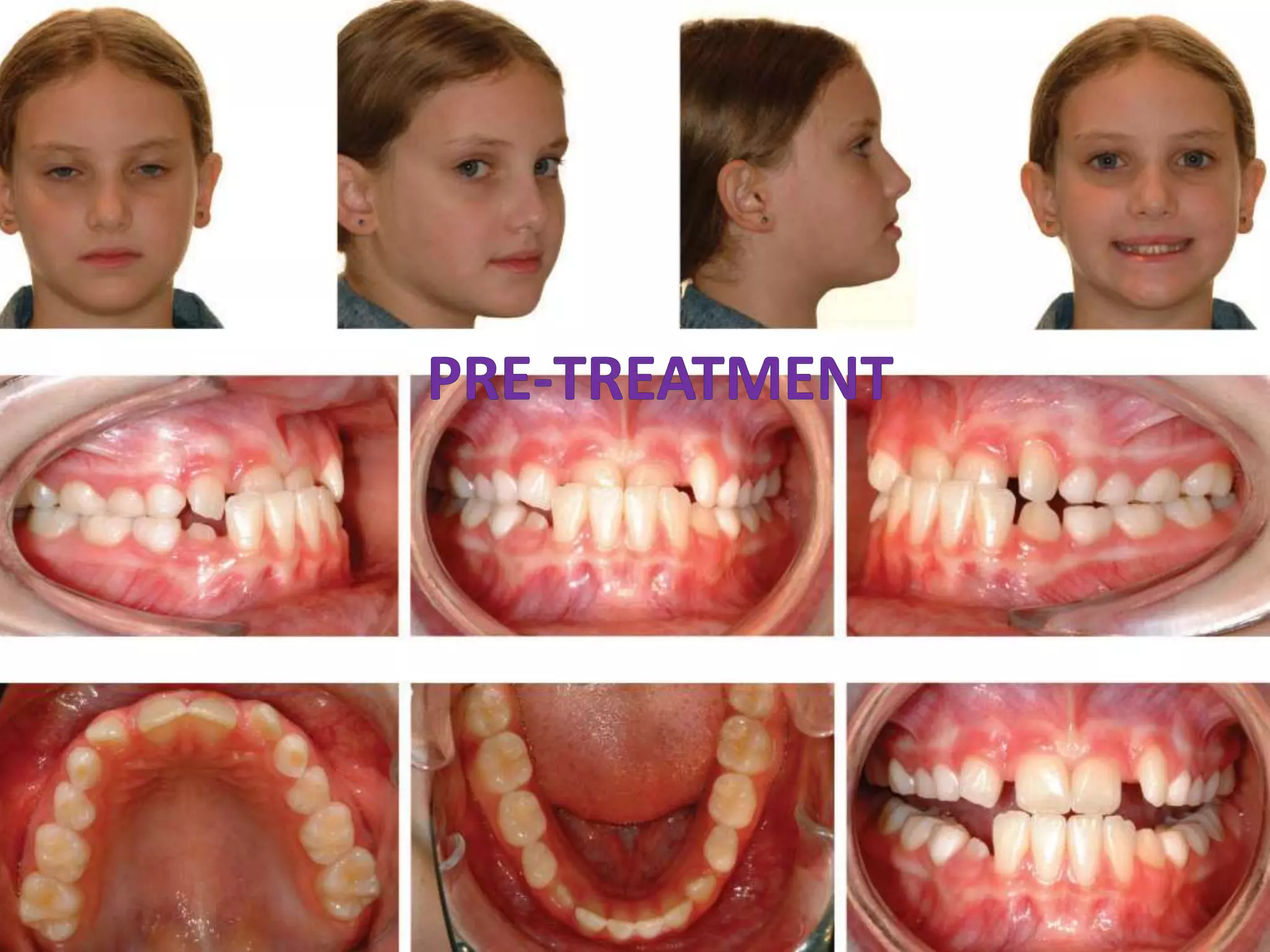 Sectional fixed orthodontic appliance | PPTX