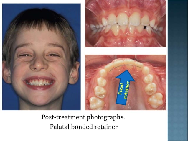 Sectional fixed orthodontic appliance | PPTX