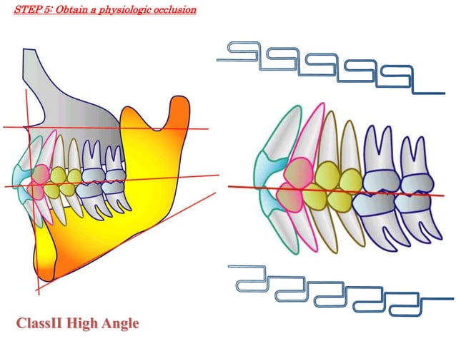 Secuencia de los arcos Meaw Sadao Sato.pptx | Dental Health | Diseases ...
