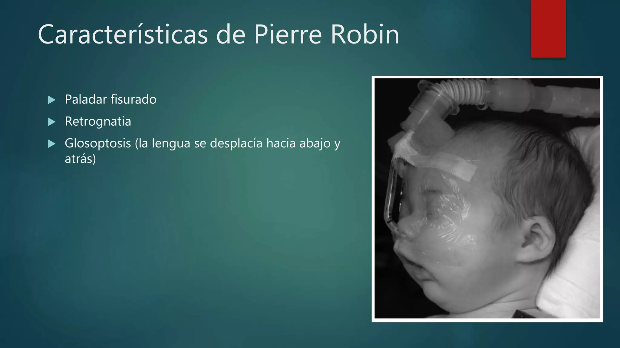 Secuencia de Pierre - Robin | PPTX