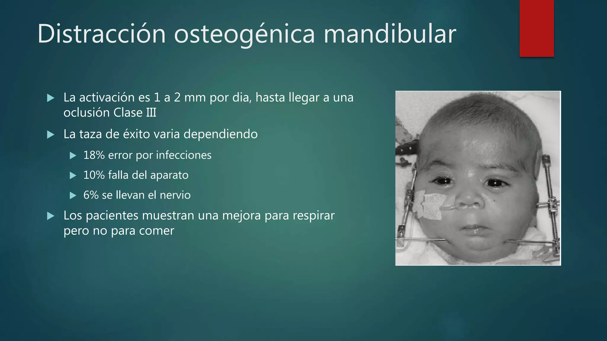 Secuencia de Pierre - Robin | PPTX