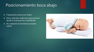 Secuencia de Pierre - Robin | PPTX