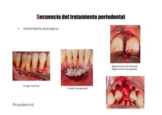 Secuencia de tratamientos periodontal | PDF
