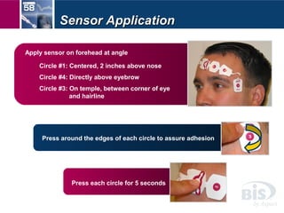 Sedation BIS monitorage | PPT