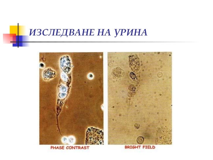 Изследване на урина, уринен седимент, хематурия (диагностични аспекти)