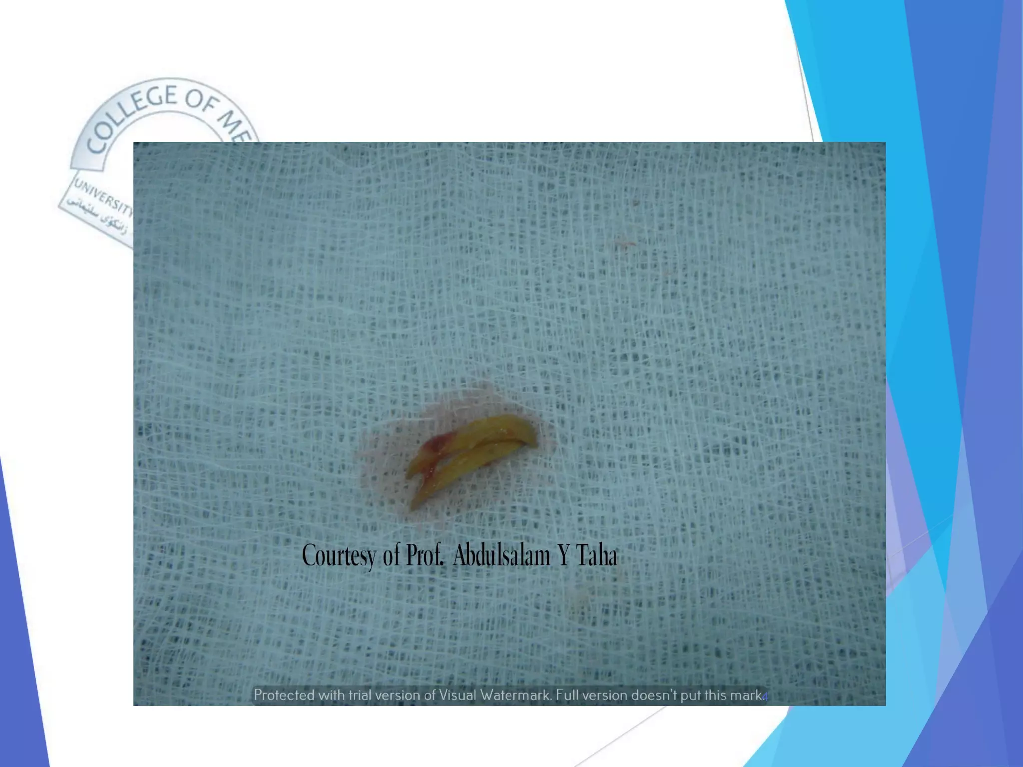 Seed in the Left Main Stem Bronchus.pdf