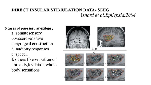 Stereo EEG or invasive EEG in Surgical epileptology.pptx