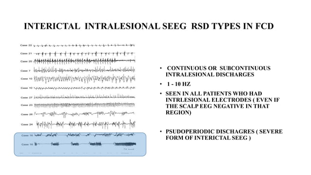 Stereo EEG or invasive EEG in Surgical epileptology.pptx