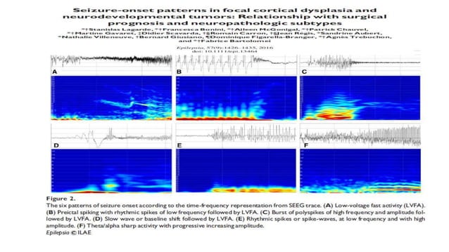 Stereo EEG or invasive EEG in Surgical epileptology.pptx