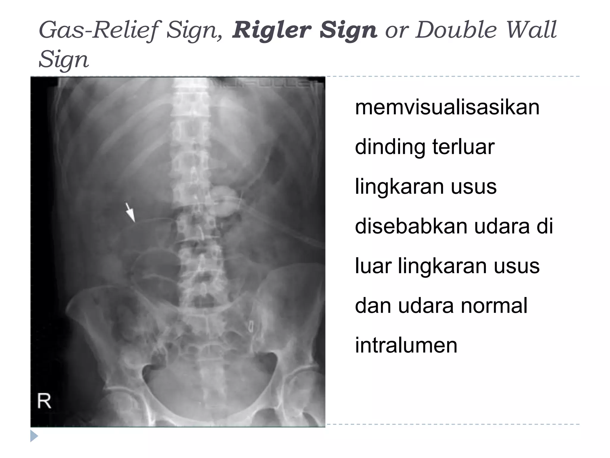 See pneumoperitoneum | PPTX