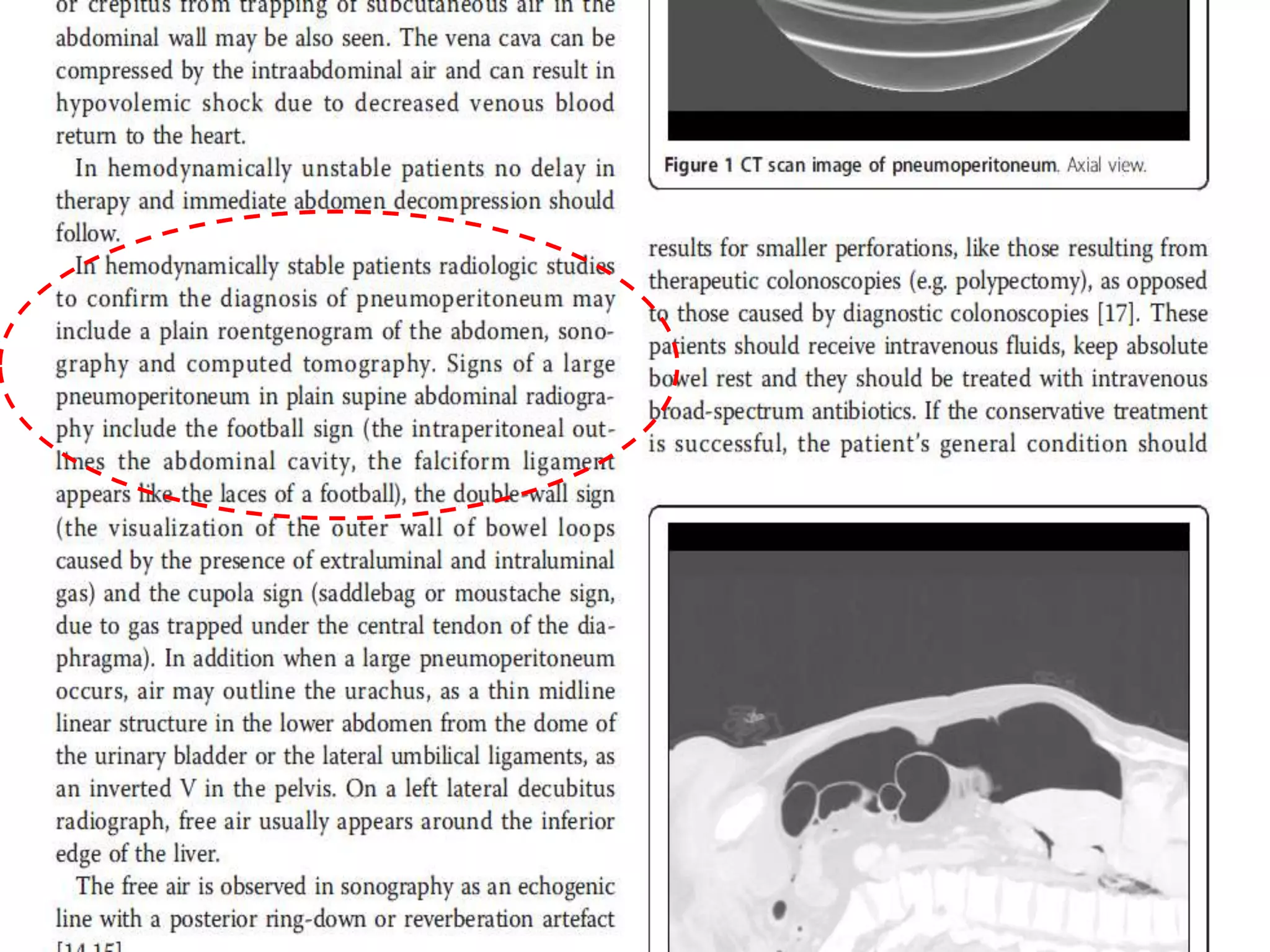 See pneumoperitoneum | PPTX