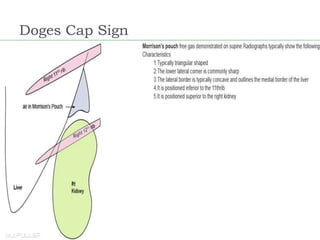 See pneumoperitoneum | PPTX