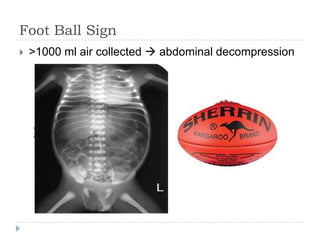 See pneumoperitoneum | PPTX