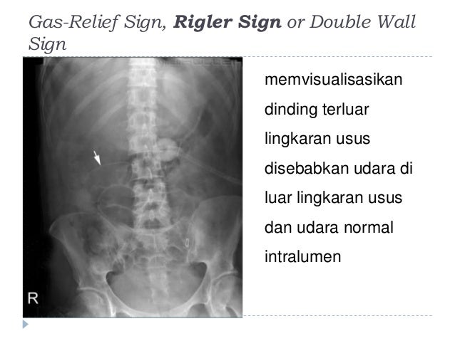 See pneumoperitoneum