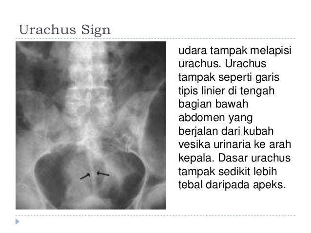See pneumoperitoneum