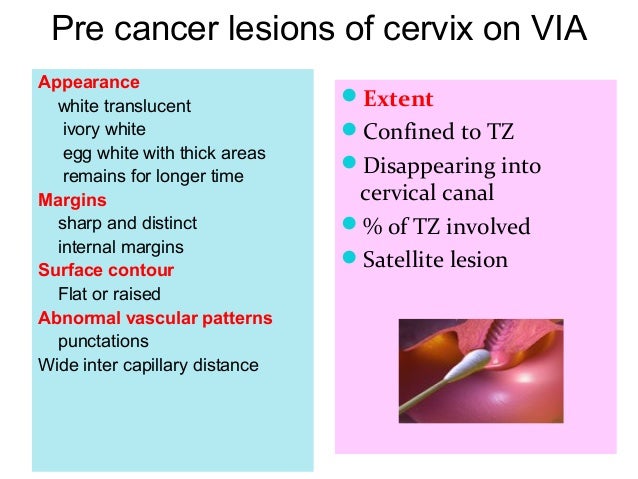 Cervical Cancer Prevention in Poor Resource areas : See & treatapproa…