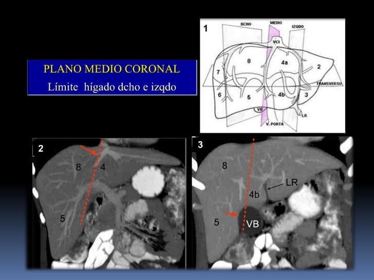 Segmentacion hepatica por Imagen seccional