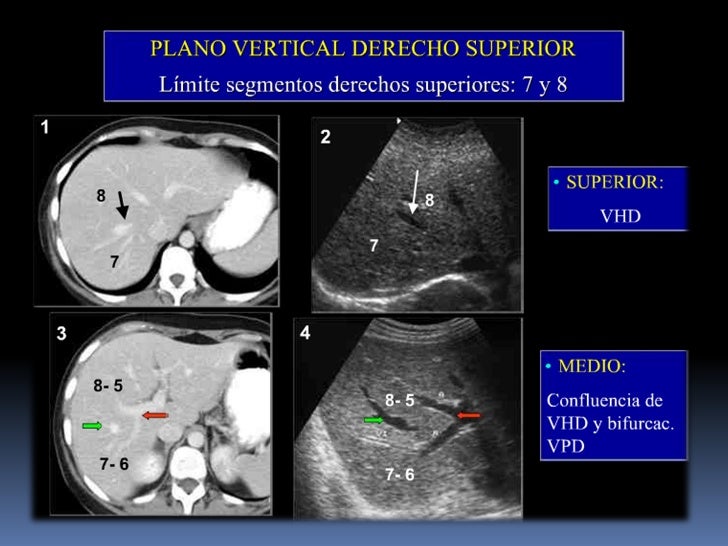 Segmentacion hepatica por Imagen seccional