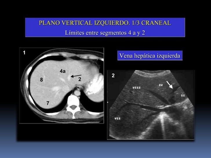 Segmentacion hepatica por Imagen seccional