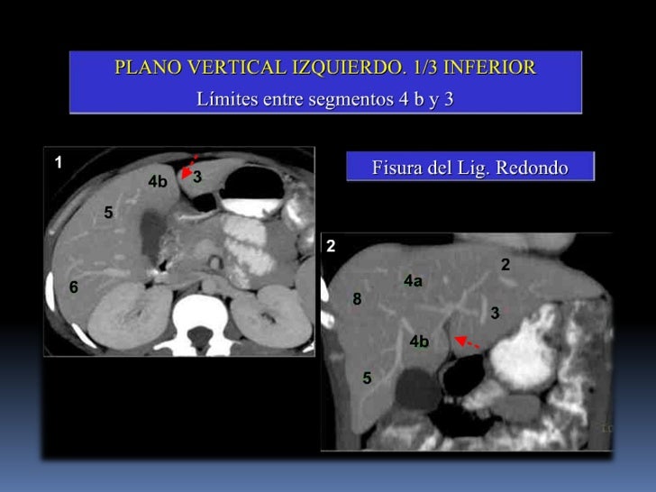Segmentacion hepatica por Imagen seccional