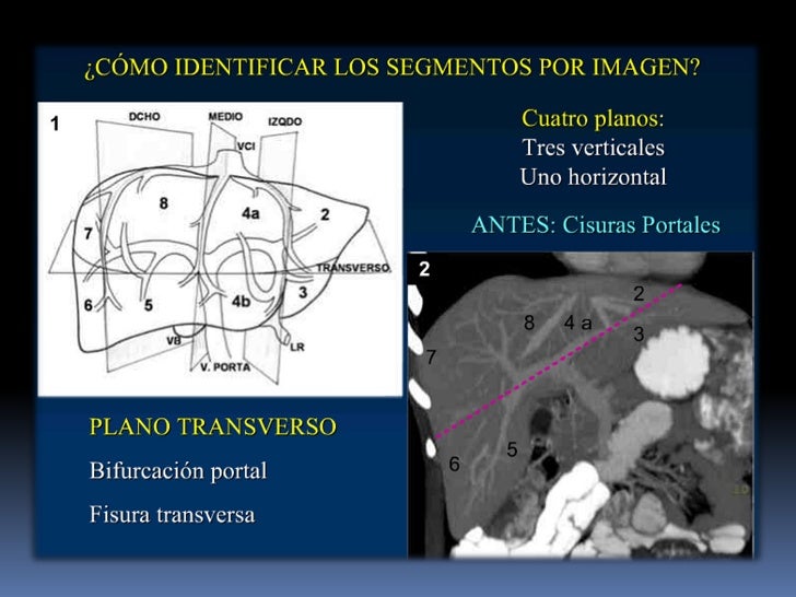 Segmentacion hepatica por Imagen seccional