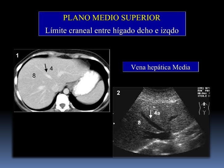 Segmentacion hepatica por Imagen seccional