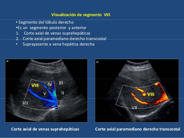 Segmentacion hepatica ecografia