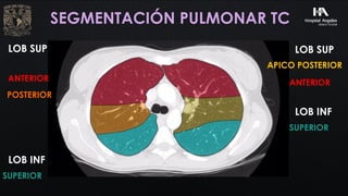 SEGMENTACION PULMONAR POR REVISION RADIOLOGIA | PPTX