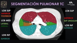 SEGMENTACION PULMONAR POR REVISION RADIOLOGIA | PPTX