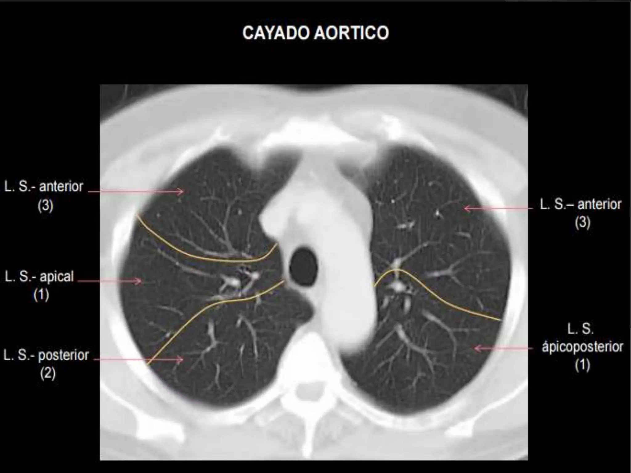 Segmentacion pulmonar tac | PPTX