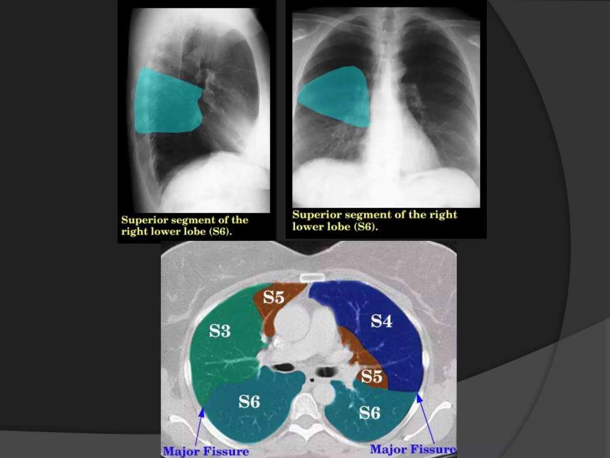 Segmentacion pulmonar tac | PPTX