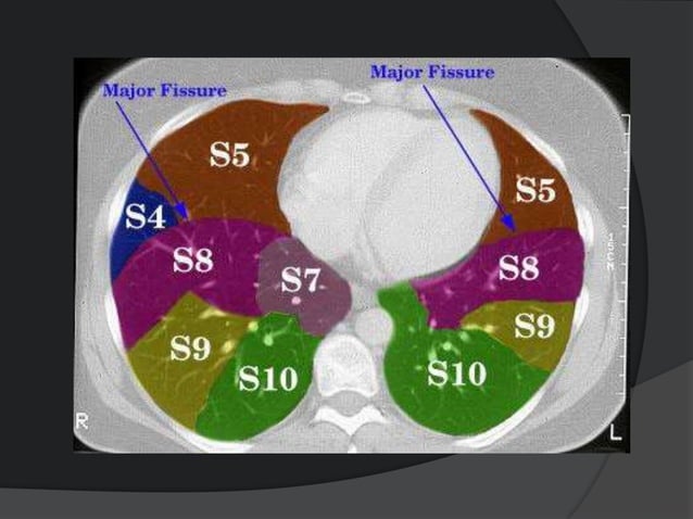 Segmentacion pulmonar tac | PPTX