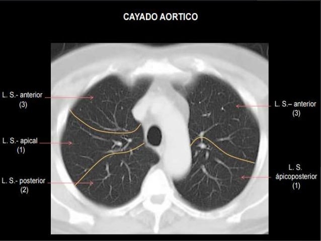 Segmentacion pulmonar tac