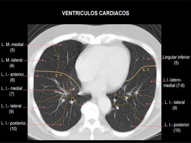 Segmentacion pulmonar tac