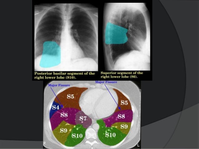 Segmentacion pulmonar tac