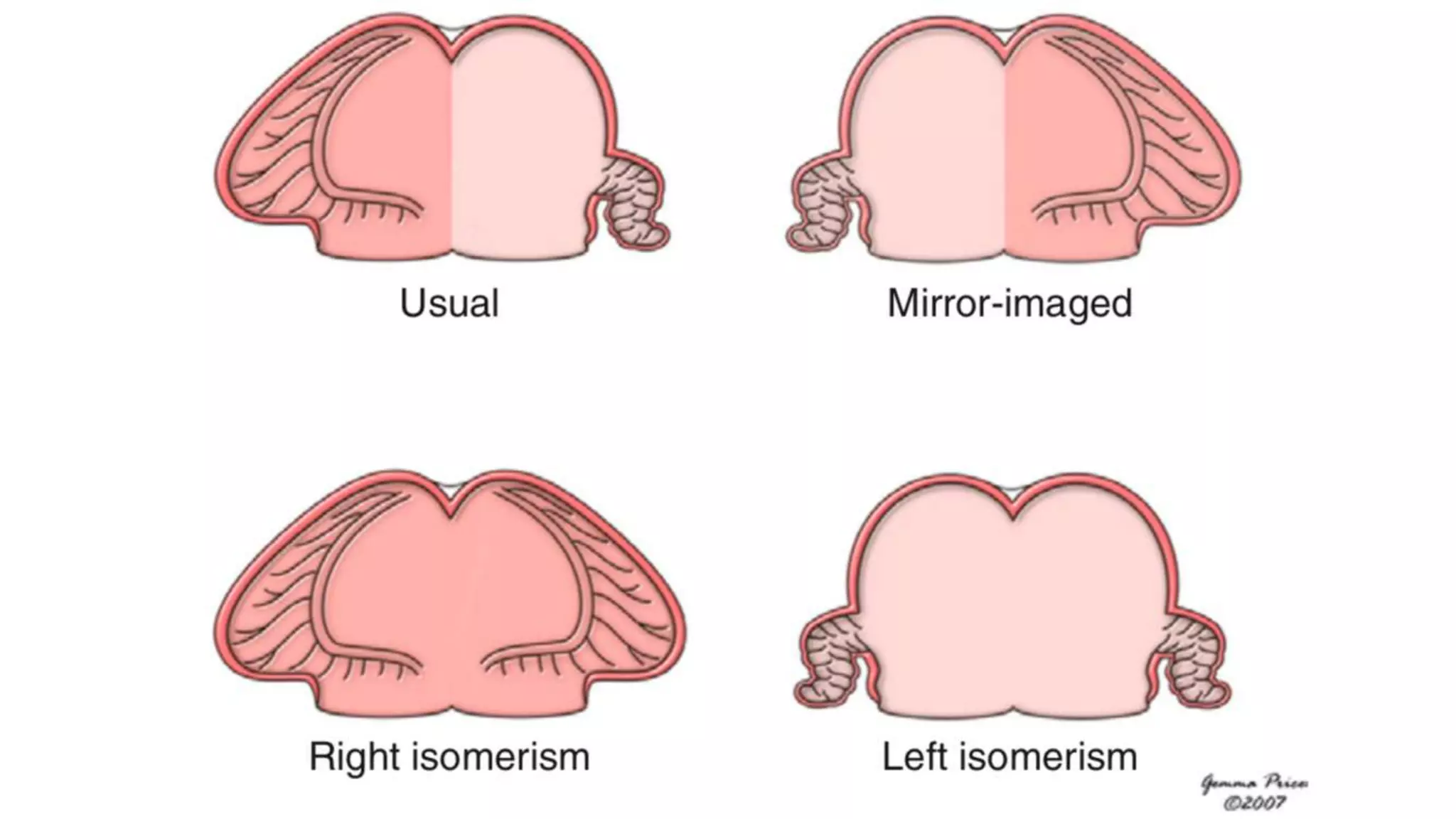 Segmental analysis of heart anatomy | PPTX