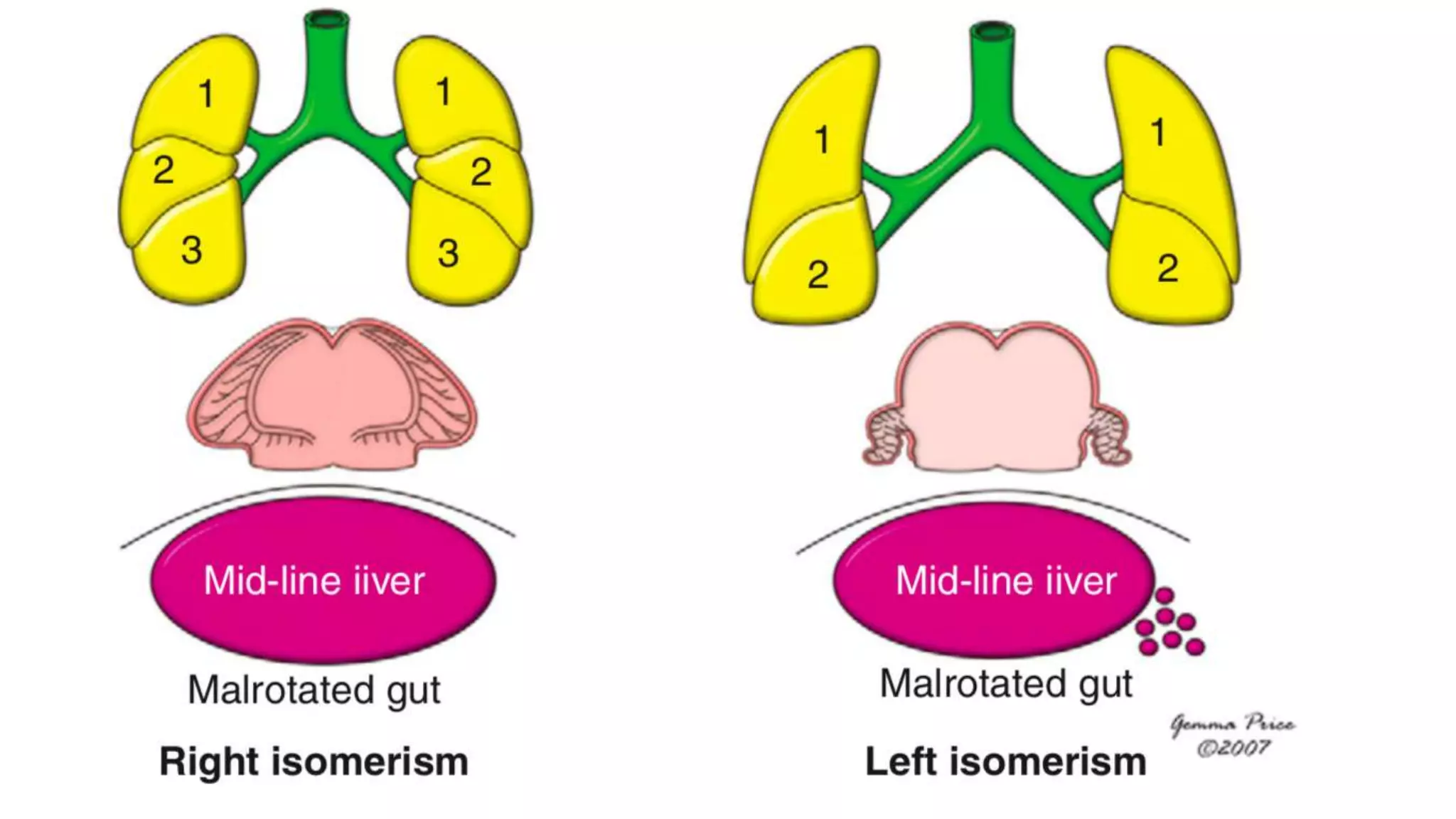 Segmental analysis of heart anatomy | PPTX