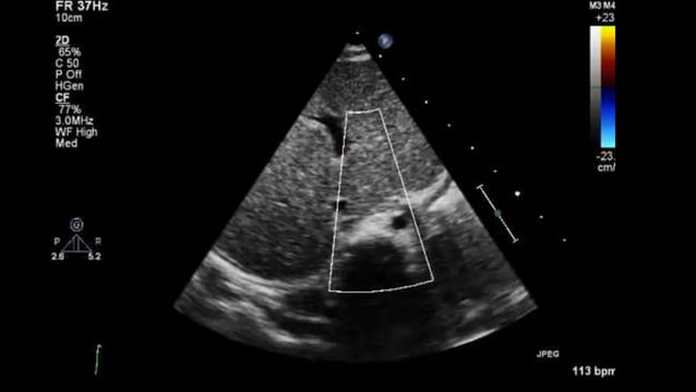Segmental analysis of heart anatomy | PPTX | Heart and Cardiovascular ...