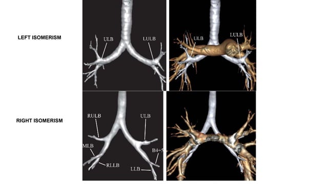 Segmental analysis of heart anatomy | PPTX | Heart and Cardiovascular ...
