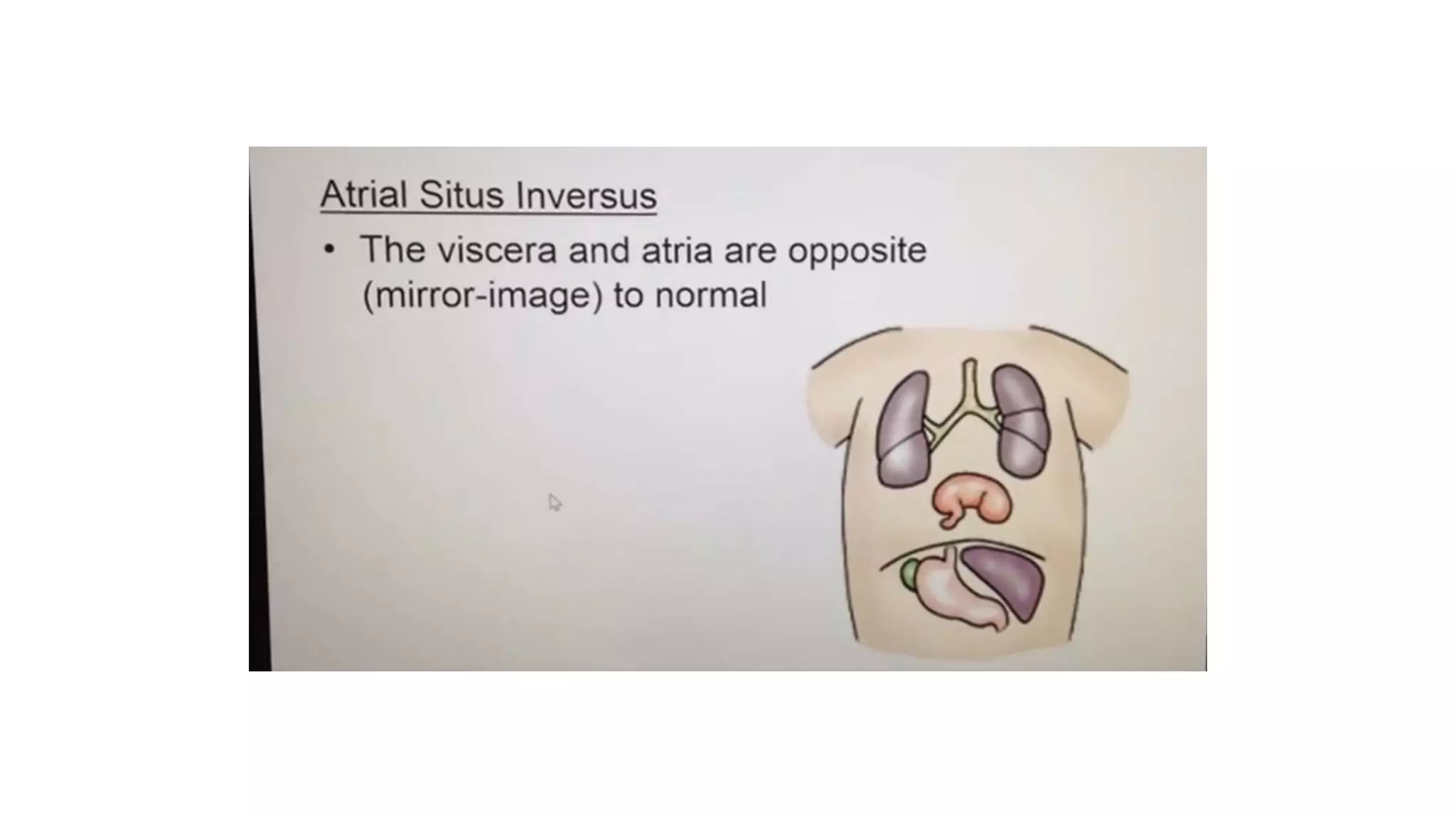 Segmental analysis in congenital heart diseases m.gibreel | PPTX