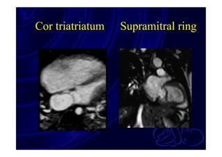 Segmental approach and evaluation of cardiac morphology | PDF