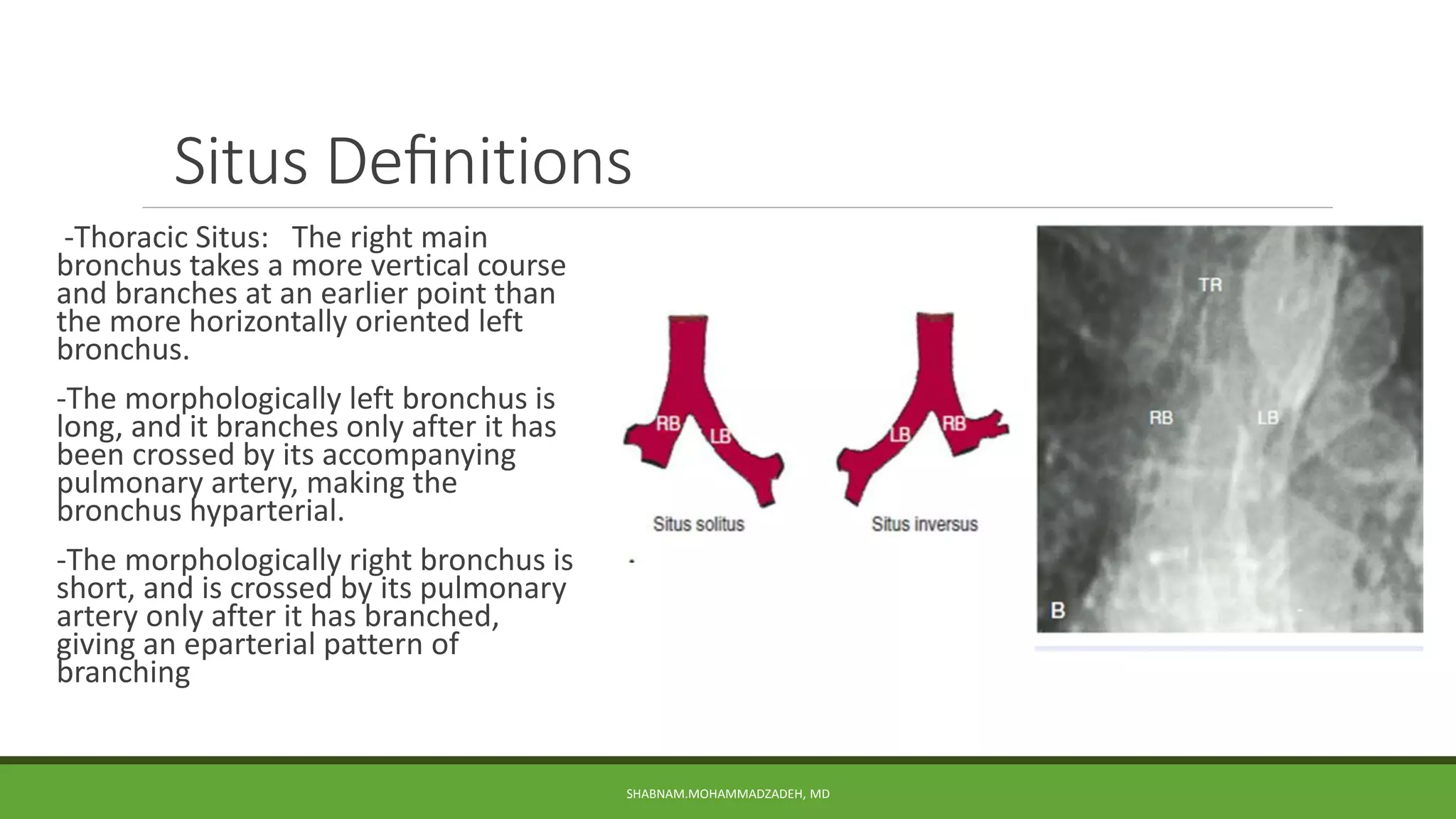 Segmental approach in congenital heart disease [autosaved].pptx 2.pptx ...