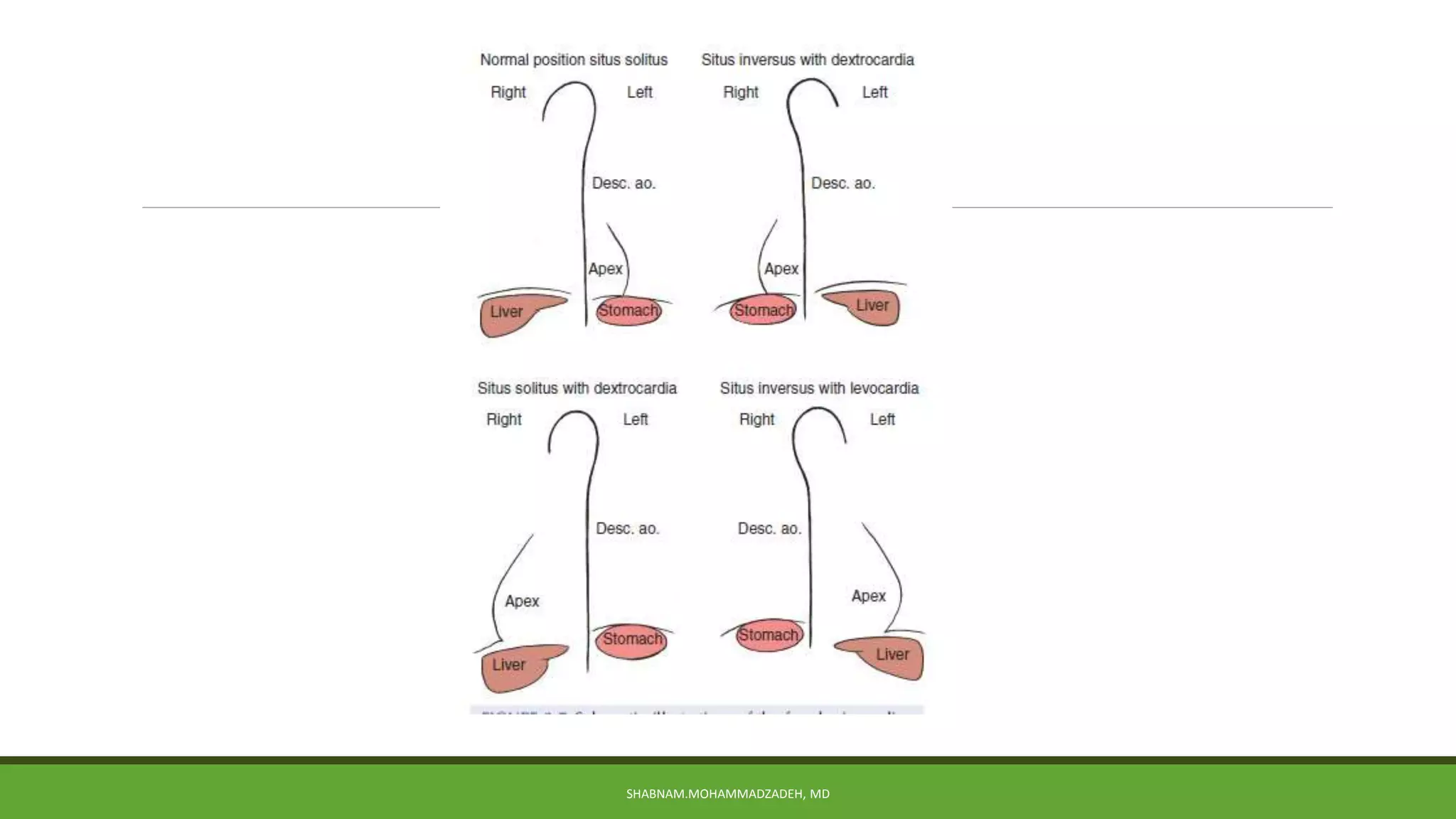 Segmental approach in congenital heart disease [autosaved].pptx 2.pptx ...