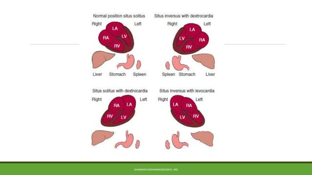 Segmental approach in congenital heart disease [autosaved].pptx 2.pptx ...