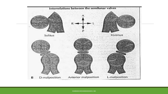 Segmental approach in congenital heart disease [autosaved].pptx 2.pptx ...
