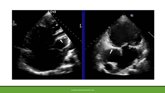Segmental approach in congenital heart disease [autosaved].pptx 2.pptx ...